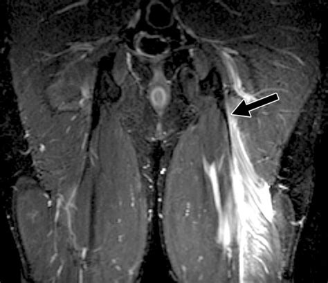 Hamstring Infortuni E Return To Play • Performancelab