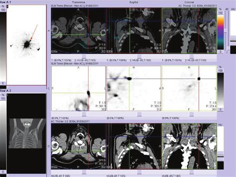 The Same Patient As In The Figure 3 And 4 Fusion Of Spect And Ct Download Scientific Diagram