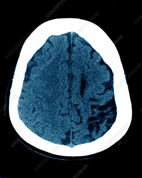 Cerebral Atrophy Ct Scan Stock Image C0254456 Science Photo Library