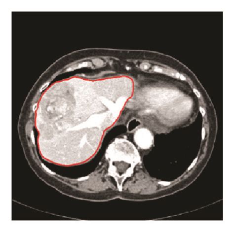 Some Randomly Selected Liver Segmentation Results Denoted In Red
