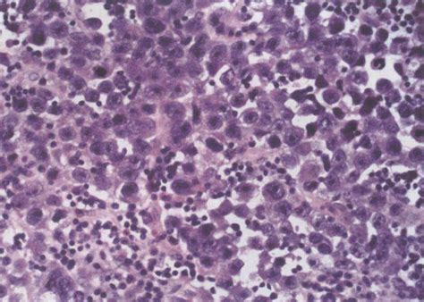 生殖细胞肿瘤 外科学 医学