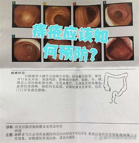 痔疮应该如何预防？