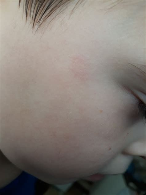 Высыпания только на лице у ребенка 5 лет Вопрос дерматологу 03 Онлайн