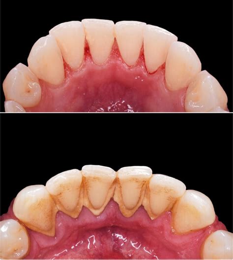 The Guide To Calcium Buildup On Teeth