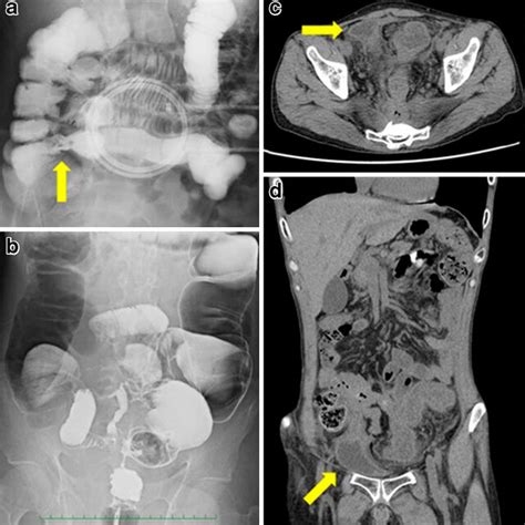 Preoperative Medical Images A Small Bowel Radiography Showed That The Download Scientific