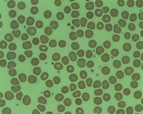Macrocytic Anaemias Almostadoctor