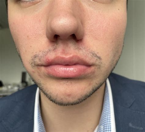 Help Rperioraldermatitis
