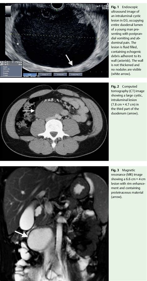 Pdf Duodenal Duplication Cyst Presenting With Gastric Outlet Obstruction In An Adult Male