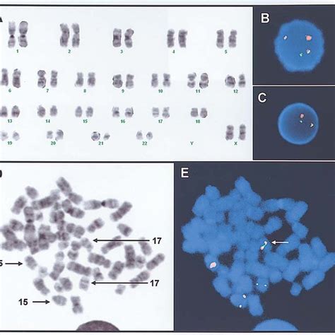 Conventional And Molecular Cytogenetic Analysis Of Case 52 A