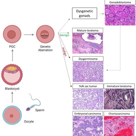Patients With Disordered Female Gonadal Development Caused By Various
