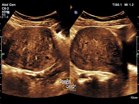 Case 119 Adenomyosis Uterus Ultrasound ~ Imaging Study