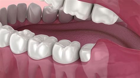 Wisdom Teeth Removal Yonge Forest Dental Dental Clinic In Barrie