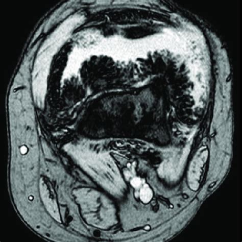 Lipoma Arborescens In A 17 Year Old Man Axial Gradient Echo Mri Shows
