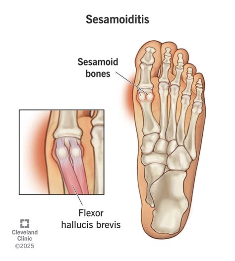 Sesamoiditis What It Is Symptoms And Treatment