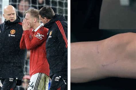 Photo Donny Van De Beek Left With Scars Following Knee Injury