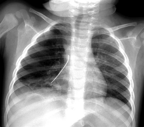 Lung Hyperlucency Chest