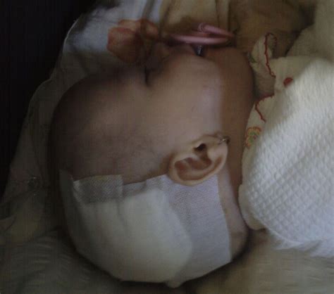 Postoperative Hydrocephalus Doccheck