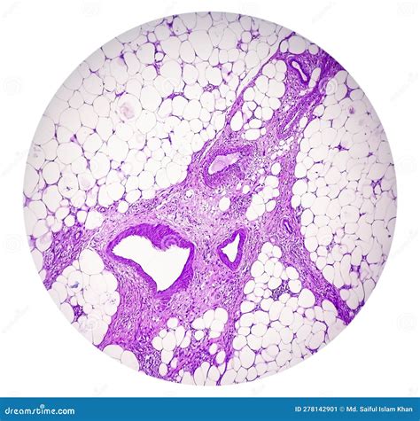 Foreign Body Granuloma Stock Image Image Of Background 278142901