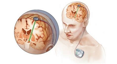 What Are The Complications Of Deep Brain Stimulation Surgery Jagtap