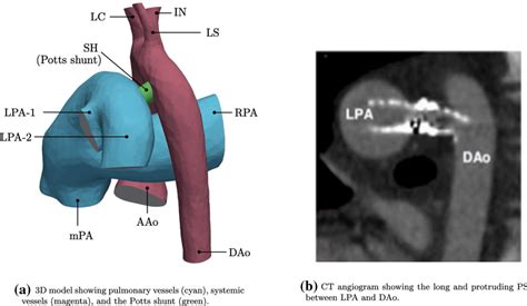 3d Reconstruction Of The Patient Anatomy And Ct Angiogram Labels Are