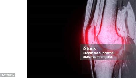 Magnetic Resonance Imaging Or Mri Of Knee Joint Sagittal Pdw For Detect