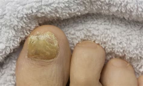 발톱무좀 없애는 방법 총정리 🔥