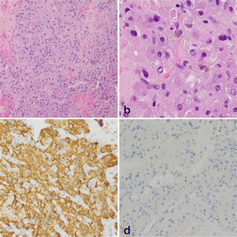 Histopathology Of Right Orbital Mass A Hematoxylin And Eosin Hande