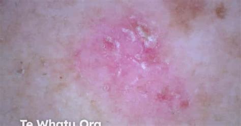 Superficial Basal Cell Carcinoma 2 Dermoscopy Image