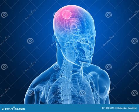 Cerebral Tumor Stock Illustration Illustration Of Neurologist 13325153