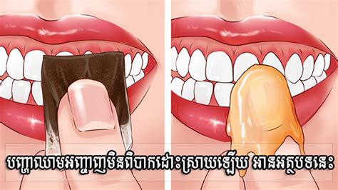 បញ្ហាឈាមអញ្ចាញមែនទេ កុំរំលងអត្ថបទនេះ Tnaot