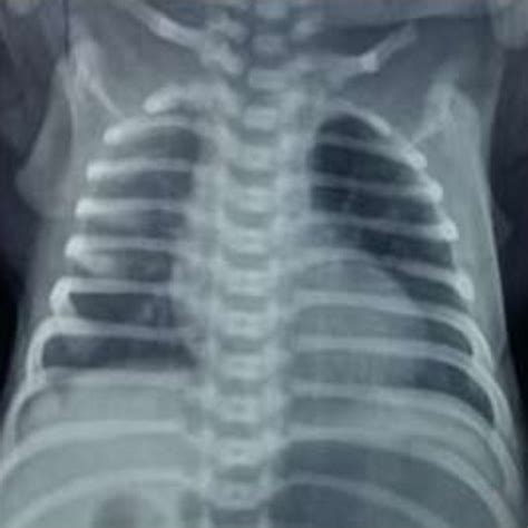 Hyperlucency Of Left Upper Zone With Herniation Of Left Upper Lobe And