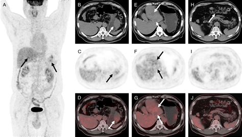 68Ga FAPI 04 PET CT Versus 18F FDG PET CT In The Detection O Clinical Nuclear Medicine