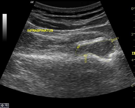 Paralabral Cyst Glenohumeral Joint Image