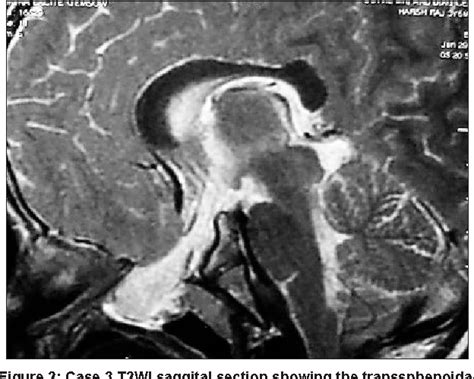 Table 1 From Transsellar Transsphenoidal Encephalocele A Series Of