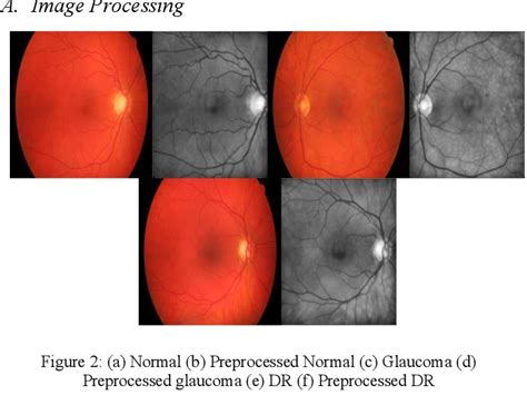 Figure 2 From Classification Of Fundus Images Using Modified Stacking