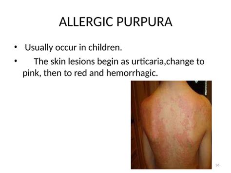 Bleeding Disorders Classification Vascular Abnormalitiespptx