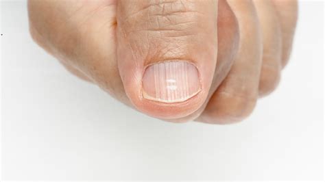 تشققات الأظافر يمكن أن تشير إلى هذه الأمراض