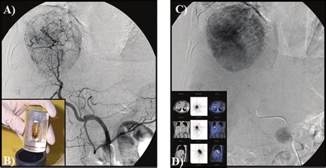 Y 90 Embolization For Hepatocellular Carcinoma A Selective