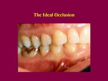 PPT The Ideal Occlusion PowerPoint Presentation Free To View Id E ZDc Z