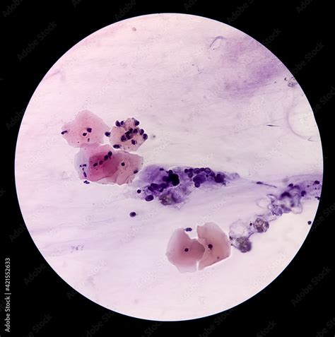 Microscopic View Of Histology Stained Slide Closeup Cell Carcinoma