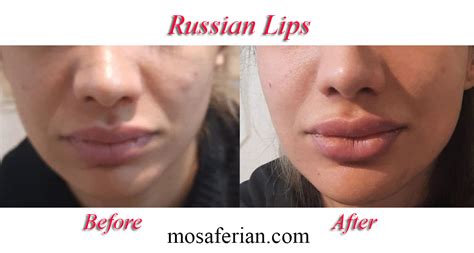 Russian Lip Filler