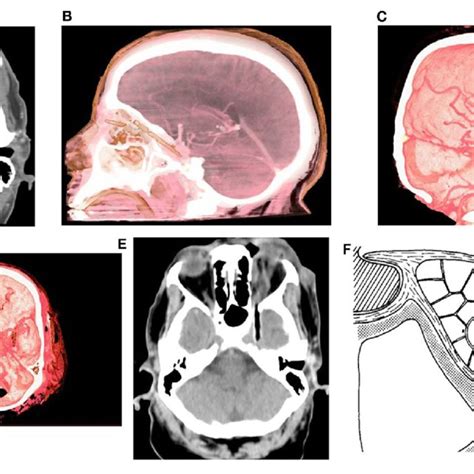 A Pre Op Ct Scan Axial View B Pre Op Cta 3d Reconstruction