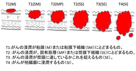 胃がんとは？ 竹村雅至先生のウェブサイト