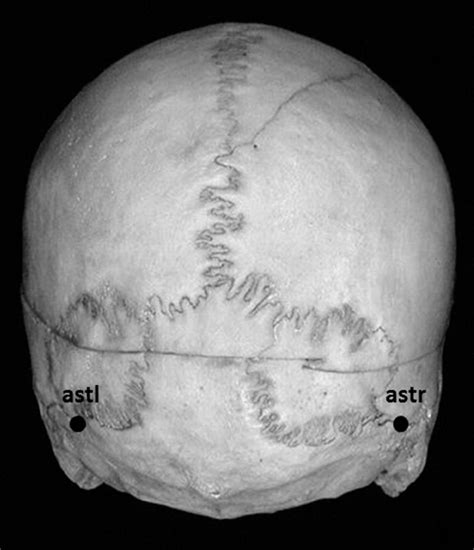 Craniofacial Landmarks Used In This Study Posterior View Download