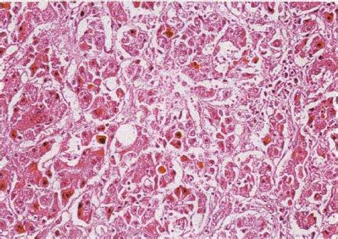 图9 85 肝内胆管上皮癌 病理组织