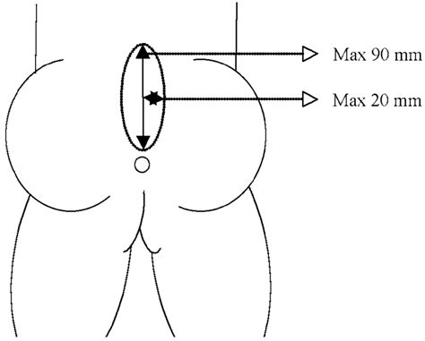 Longitudinal And Lateral Incision Margins Download Scientific Diagram