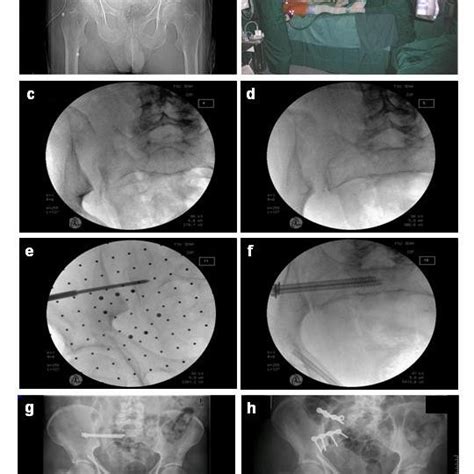 Y O Male Motorcycle Accident Pelvic Fracture C C A Download Scientific Diagram
