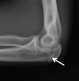 Compression Fracture Arm