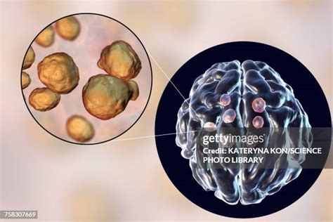 Brain Lesions Photos And Premium High Res Pictures Getty Images