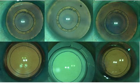 David Mordaunt On Linkedin Capsulblue Capsulotomy Capsulorhexis